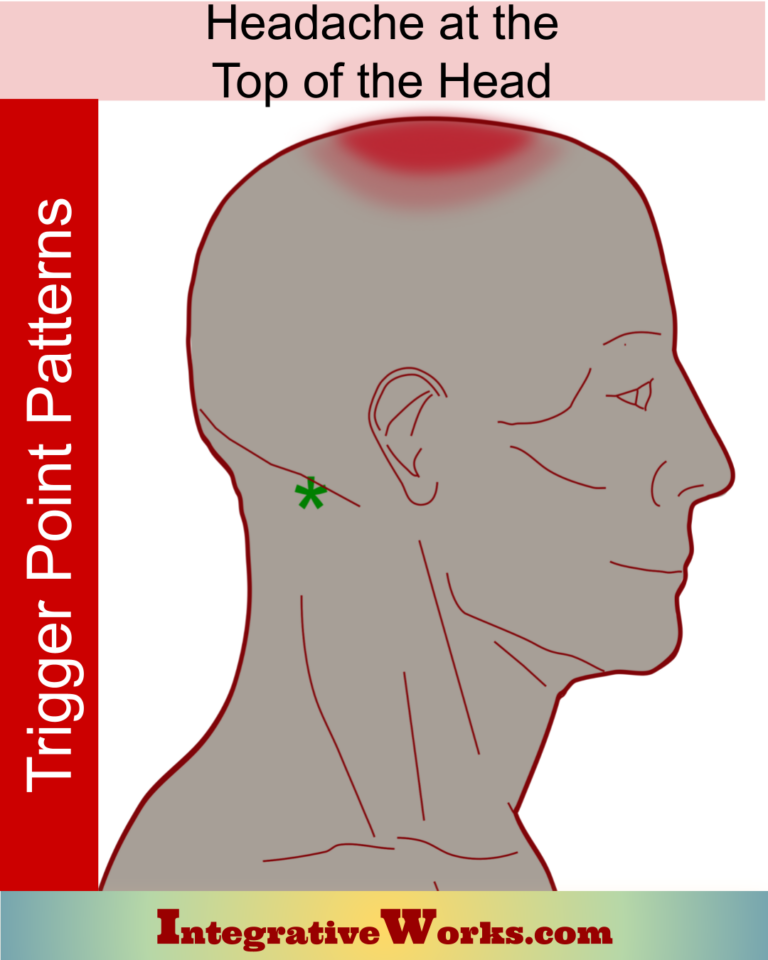 Trigger Point Pain Referral - Head - Integrative Works
