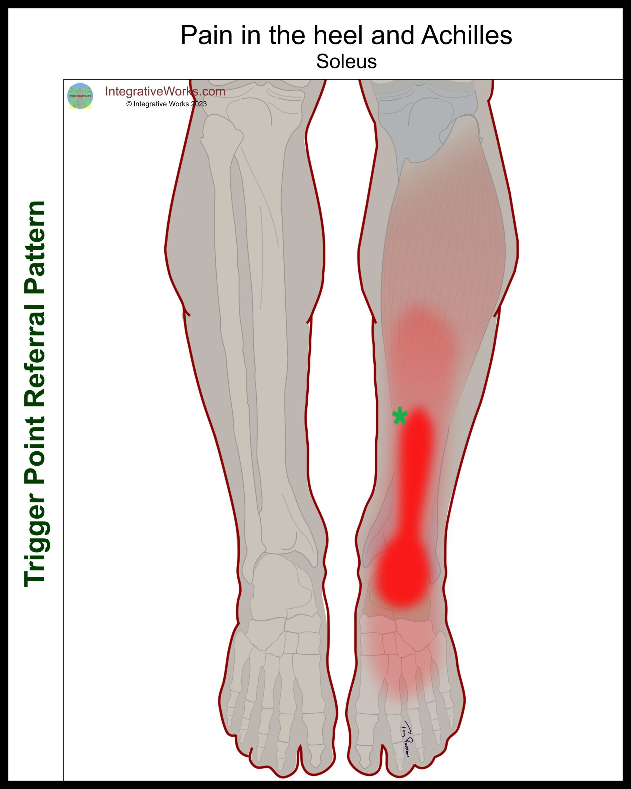 Painful Heel when Running or Sleeping - Integrative Works