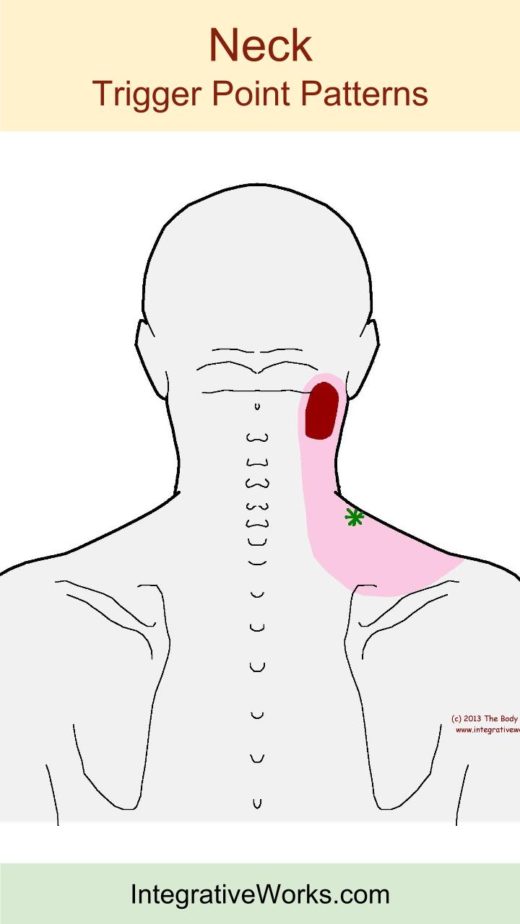 Neck - Trigger Point Pain and Impaired Function - Integrative Works