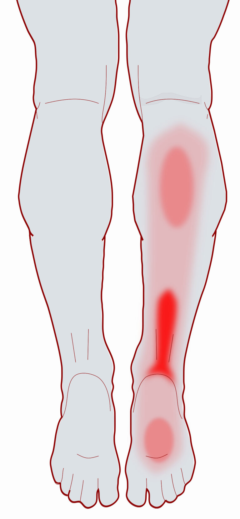 Pain in the Achilles Tendon - Integrative Works