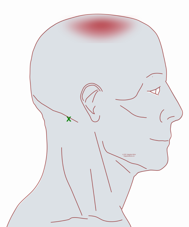 Headache on the Top of Your Head - Integrative Works