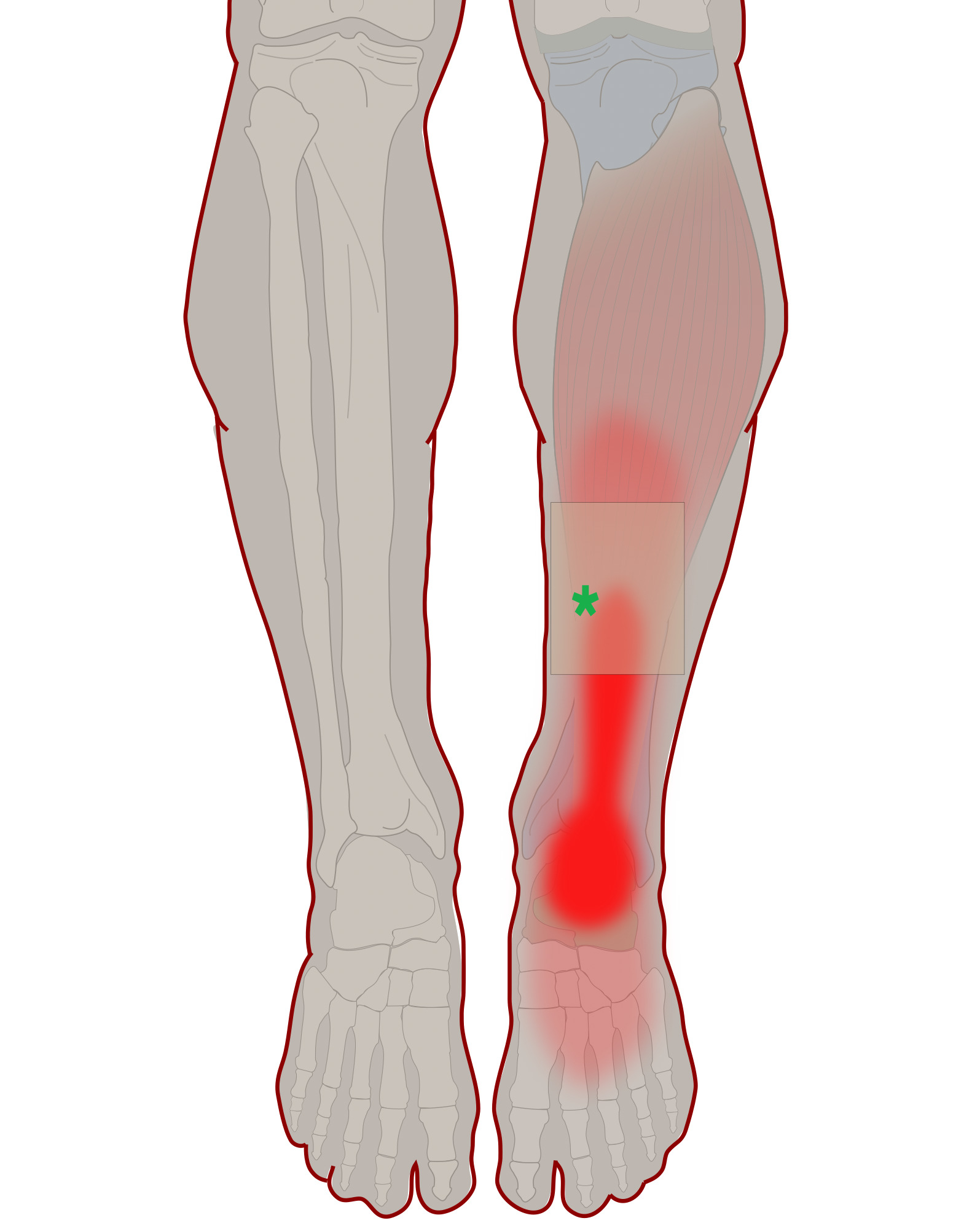 Self-Care - Soleus Pain - Integrative Works