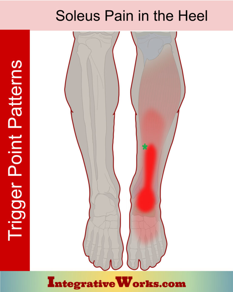 Sleeping and Trigger Points: Pain Patterns, Causes, Self-Care ...